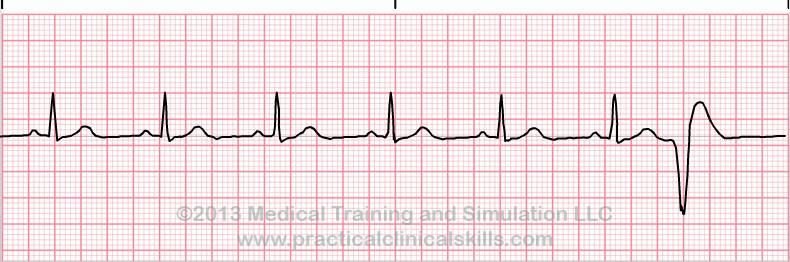 Ventricular Premature Complexes; Extrasystole, Ventricular; Premature ...